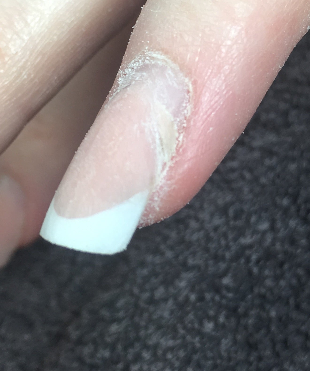 How To Correctly Remove Lifting Enhancements | Blogs - Katie Barnes ...